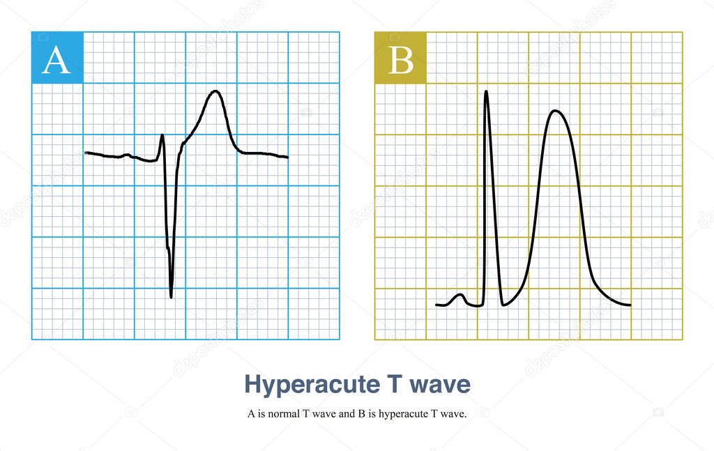 Onda T Apiculada Ecg - RETOEDU