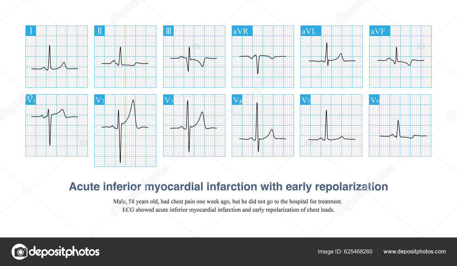 Repolarización Temprana Principalmente Cambio Benigno Del Ecg Elevación ...