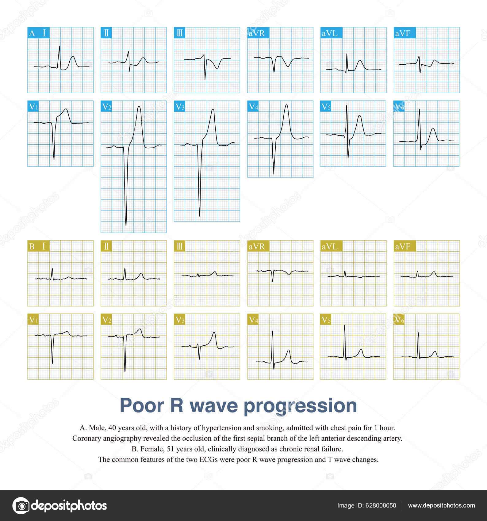 Mala Progresión Onda Puede Ver Solo Síndrome Coronario Agudo Sino ...