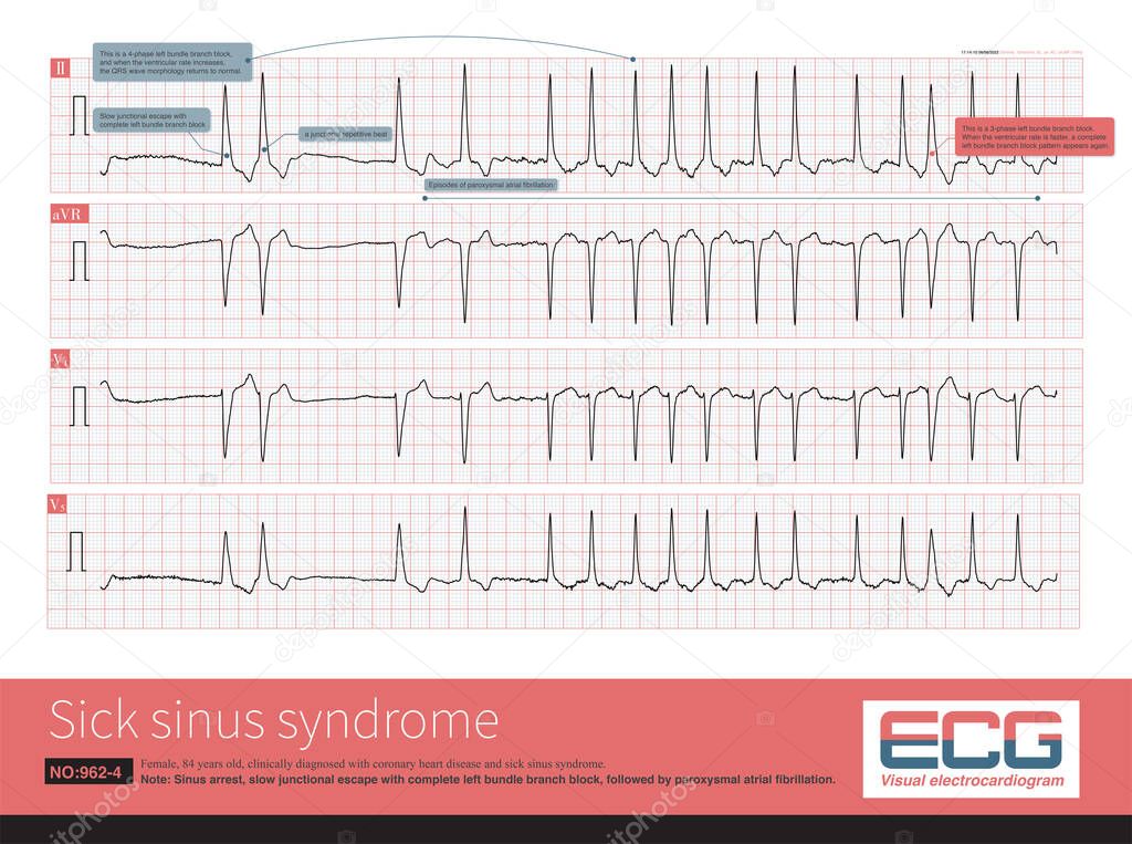 Paro sinusal, escape lento de la unión con bloqueo completo de rama ...