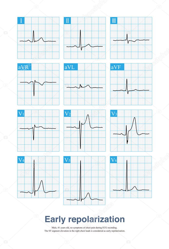 El cambio característico del ECG de la repolarización temprana es el ...