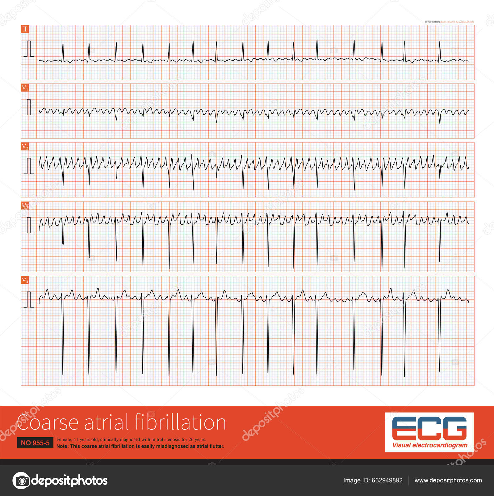 Fibrilacao Atrial Vs Flutter Atrial Ecg Flutter Atrial Com Resposta