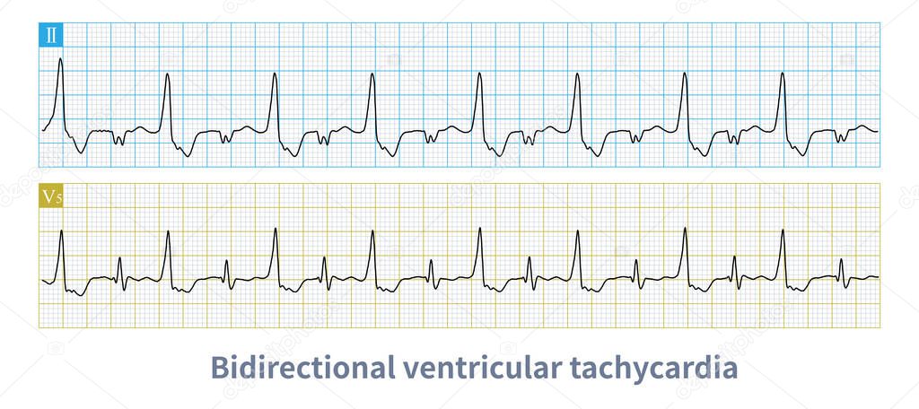 La taquicardia ventricular bidireccional es un tipo de arritmia maligna ...
