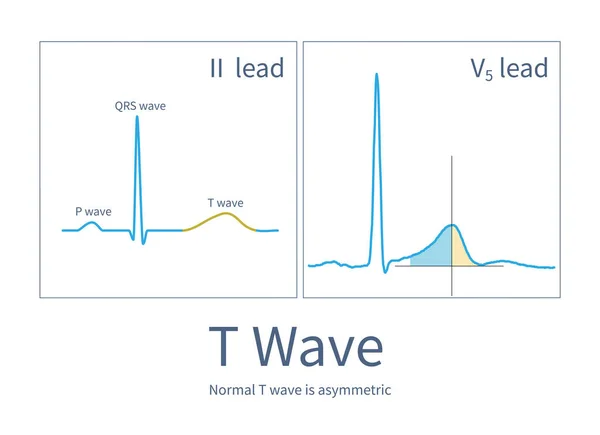 The T wave is the ventricular repolarization wave. The normal T wave is ...