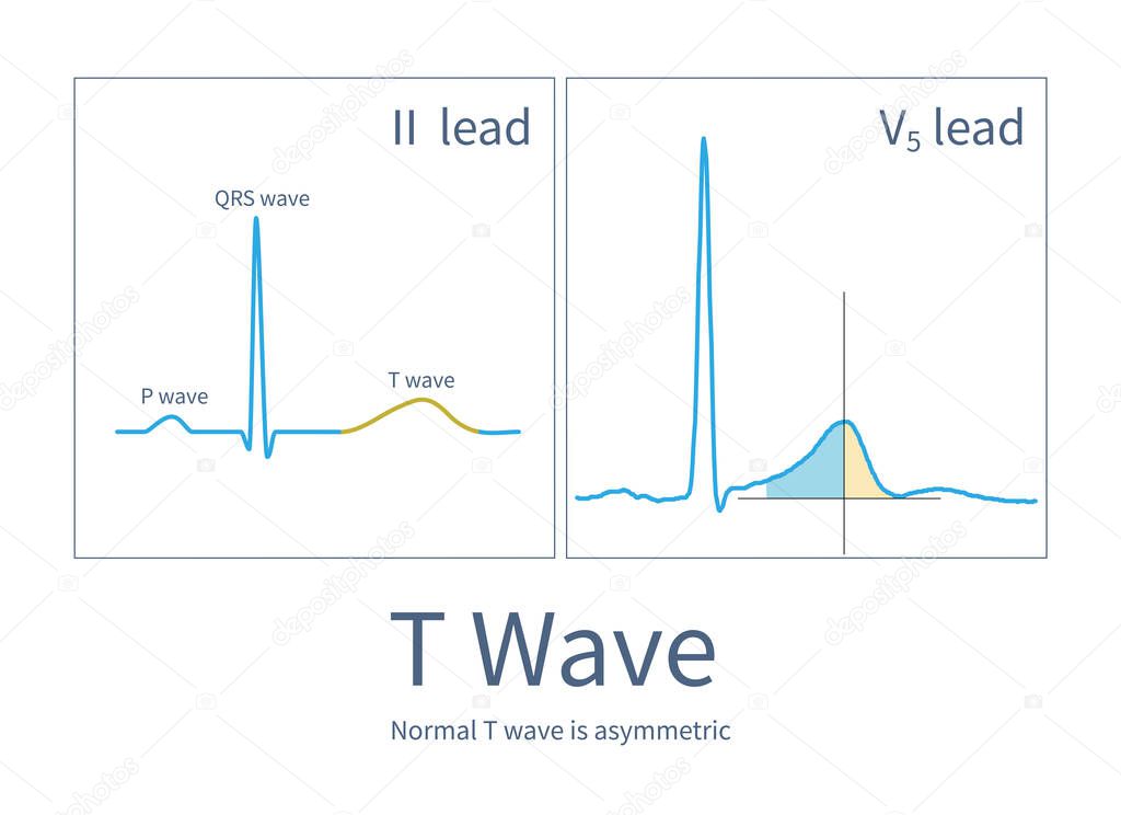 The T wave is the ventricular repolarization wave. The normal T wave is ...