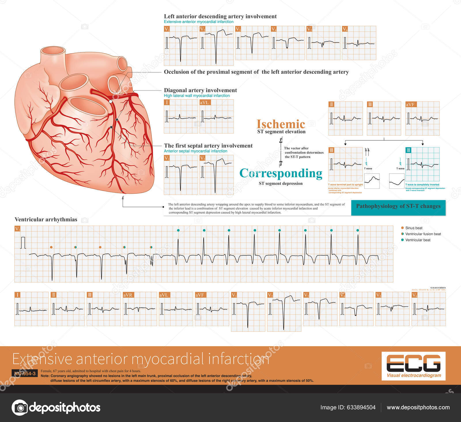 Lateral Arterial Descending