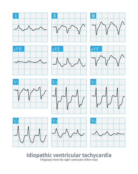 Idiopathic ventricular tachycardia Stock Photos, Royalty Free ...