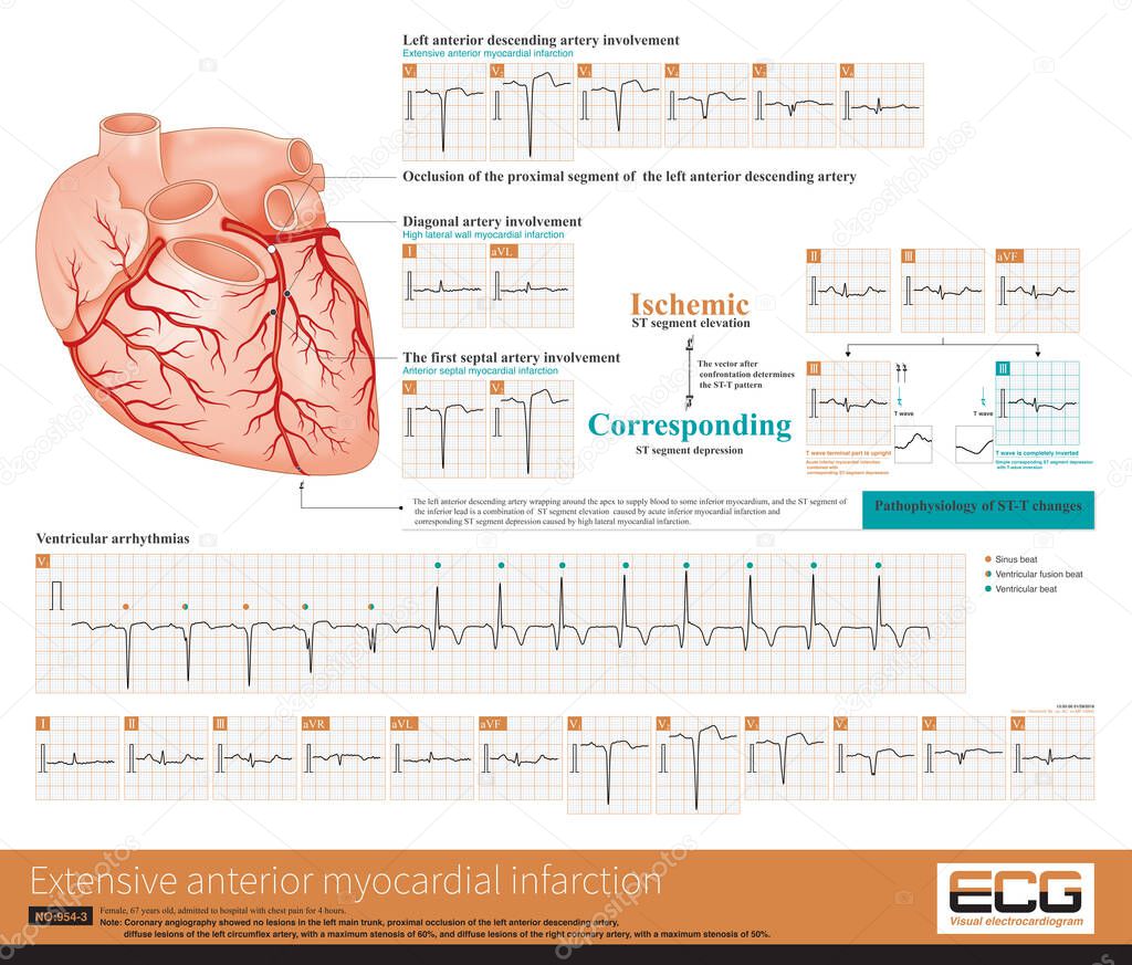 The proximal occlusion of the left anterior descending artery leads to a large area of anterior ...