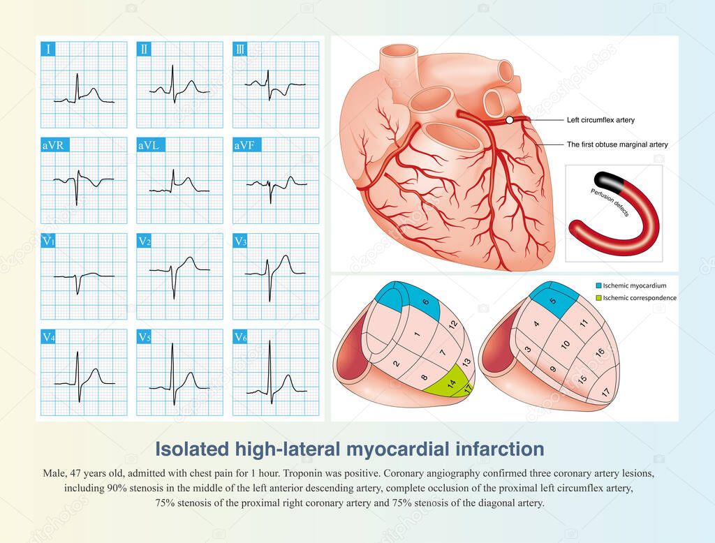 Isolated occlusion of left circumflex artery can lead to isolated high ...