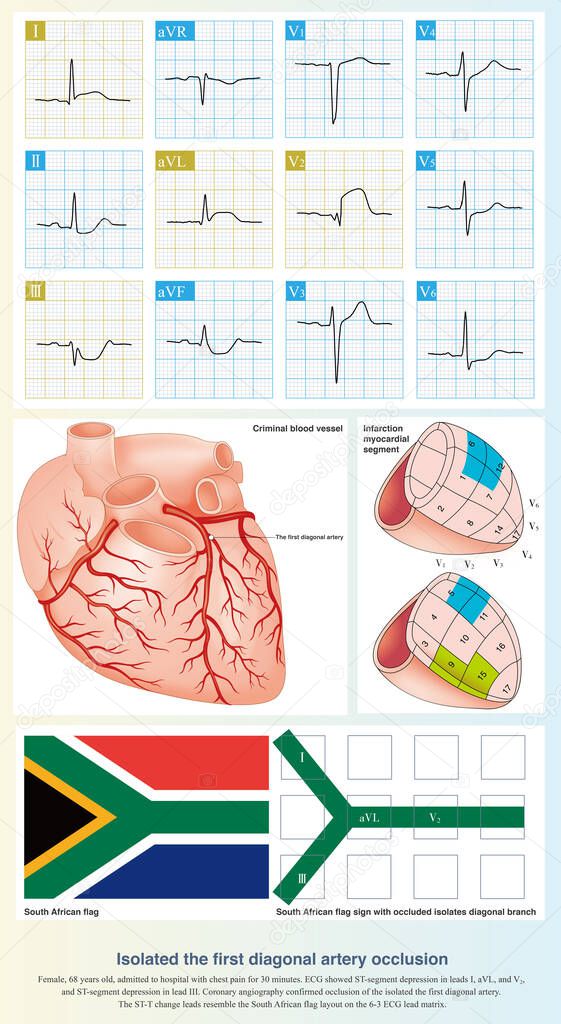When the isolated first diagonal artery is occluded, ECG can show ST ...