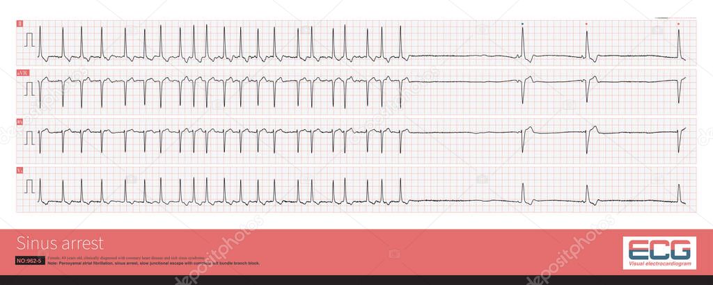 ECG of a patient with sick sinus syndrome. After a paroxysmal atrial ...