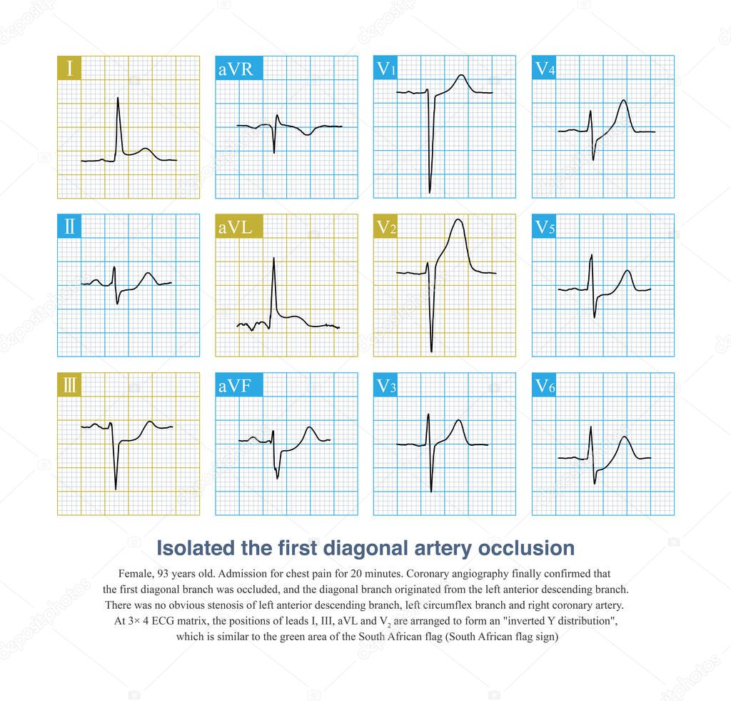 18-When the isolated first diagonal artery is occluded, ECG can show ST ...