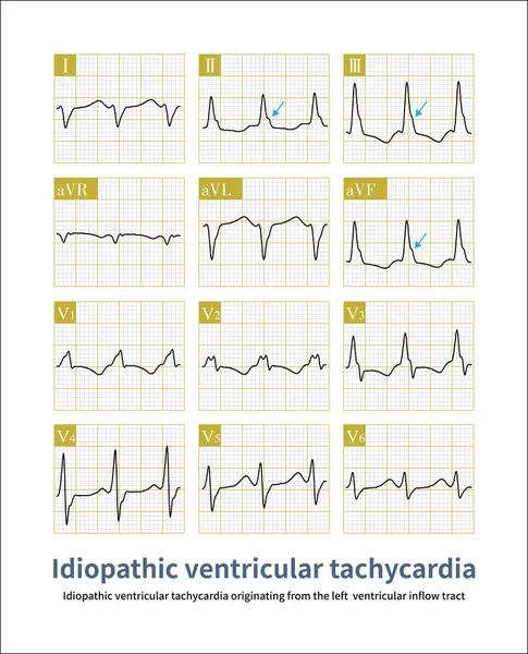 Idiopathic ventricular tachycardia Stock Photos, Royalty Free ...