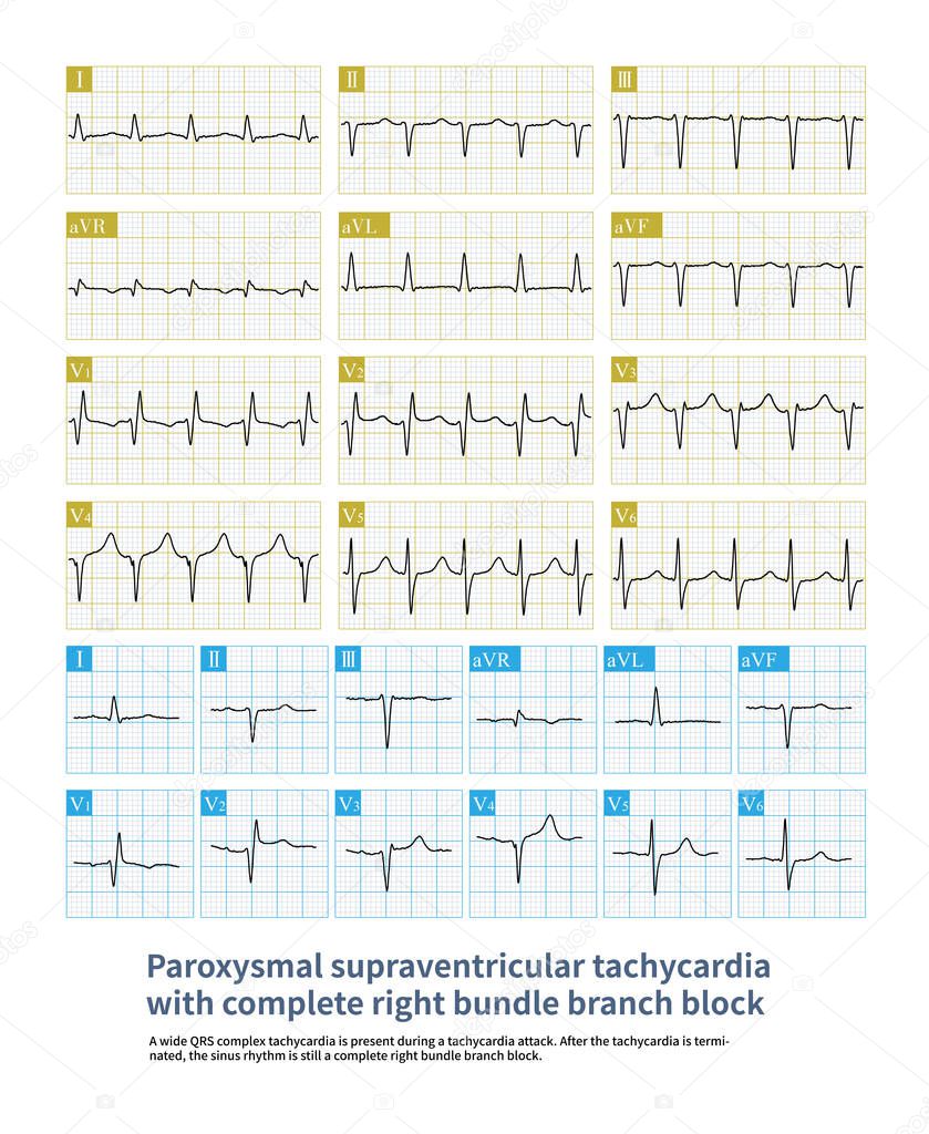 Sometimes, when supraventricular tachycardia is combined with bundle ...