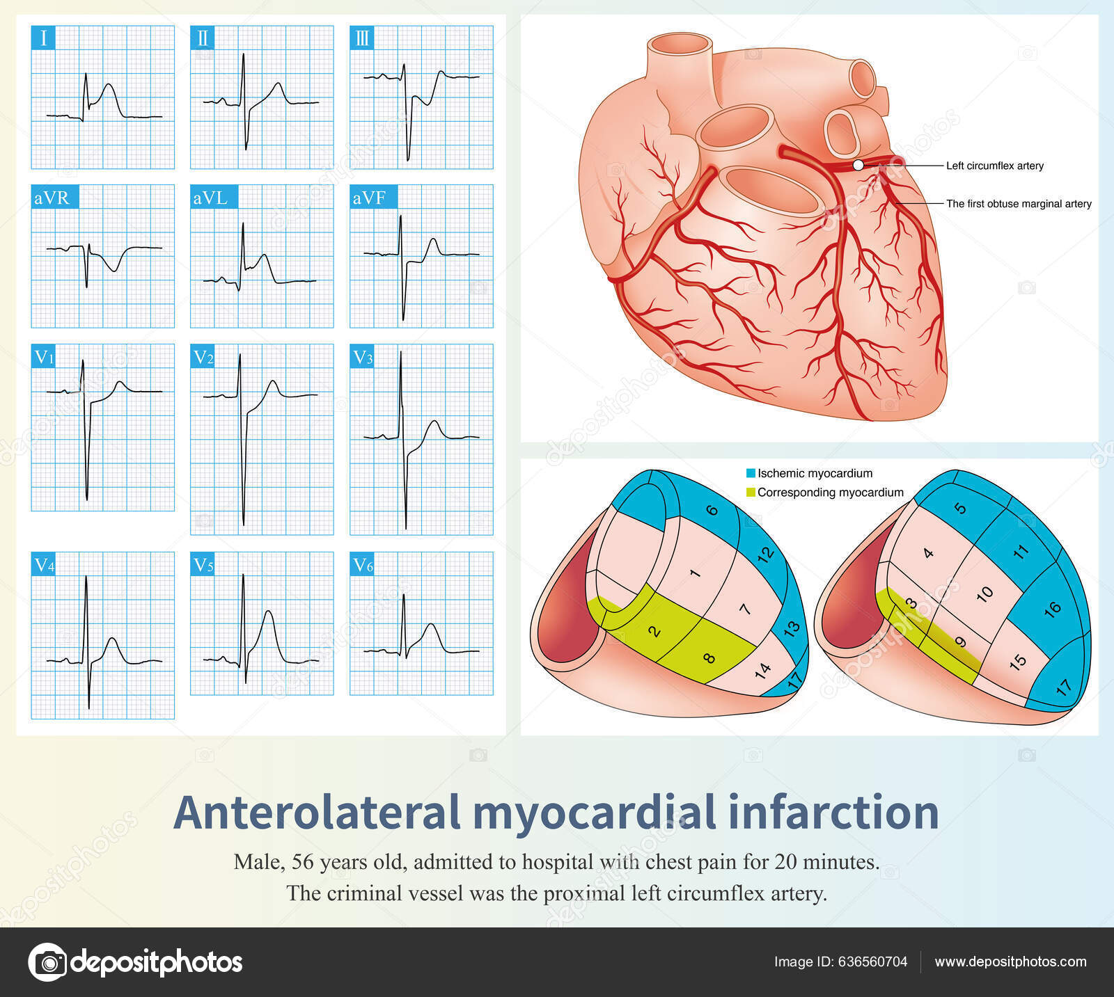 Proximal Segment Left Circumflex Artery Occluded Causes Lateral ...