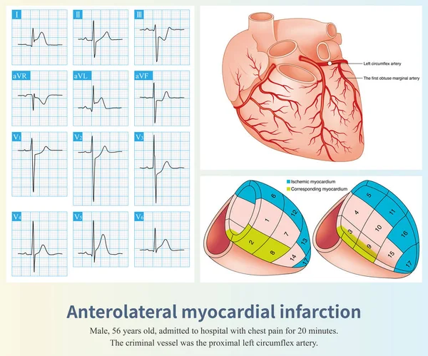 Occlusion Proximal Middle Left Circumflex Artery Can Lead Myocardial ...