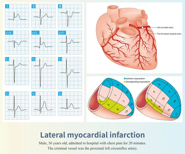Occlusion Proximal Middle Left Circumflex Artery Can Lead Myocardial Infarction — Stock Photo ...