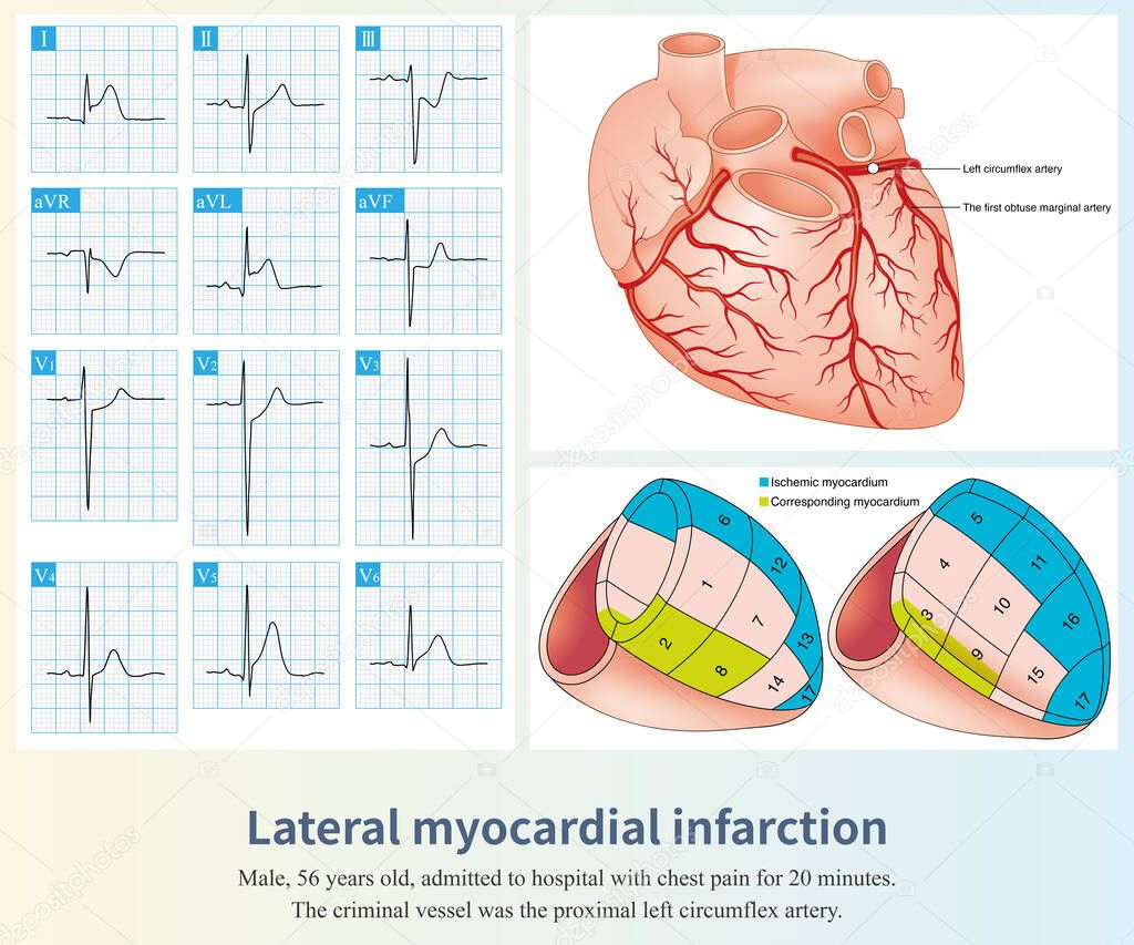 When the proximal segment of the left circumflex artery is occluded, it ...