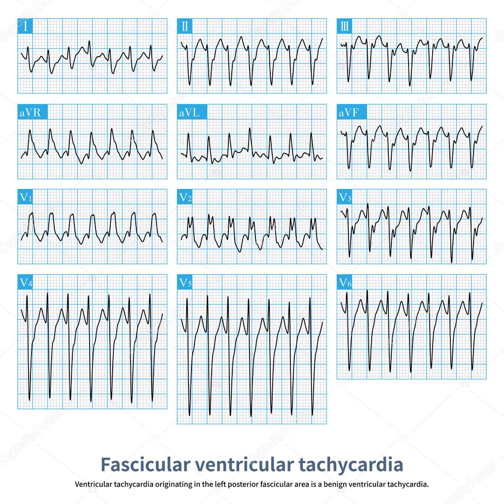 Ventricular tachycardia originating in the left posterior fascicular ...