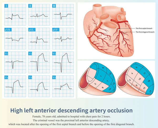 Occlusion Proximal Middle Left Circumflex Artery Can Lead Myocardial Infarction — Stock Photo ...