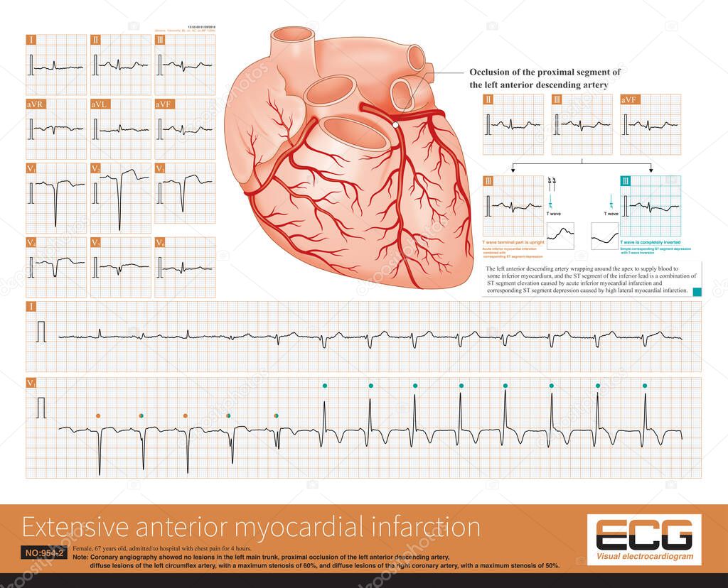 The proximal occlusion of the left anterior descending artery leads to ...