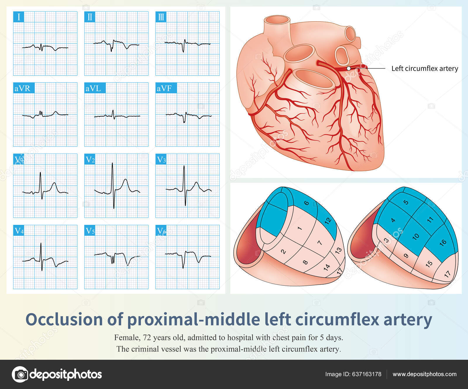 Occlusion Proximal Middle Left Circumflex Artery Can Lead Myocardial ...