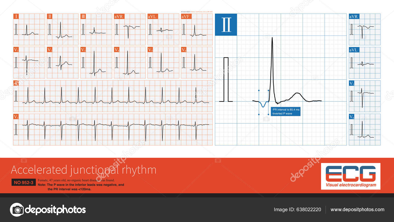 Ectopic Beats Originate Atrioventricular Junctional Region Interval ...