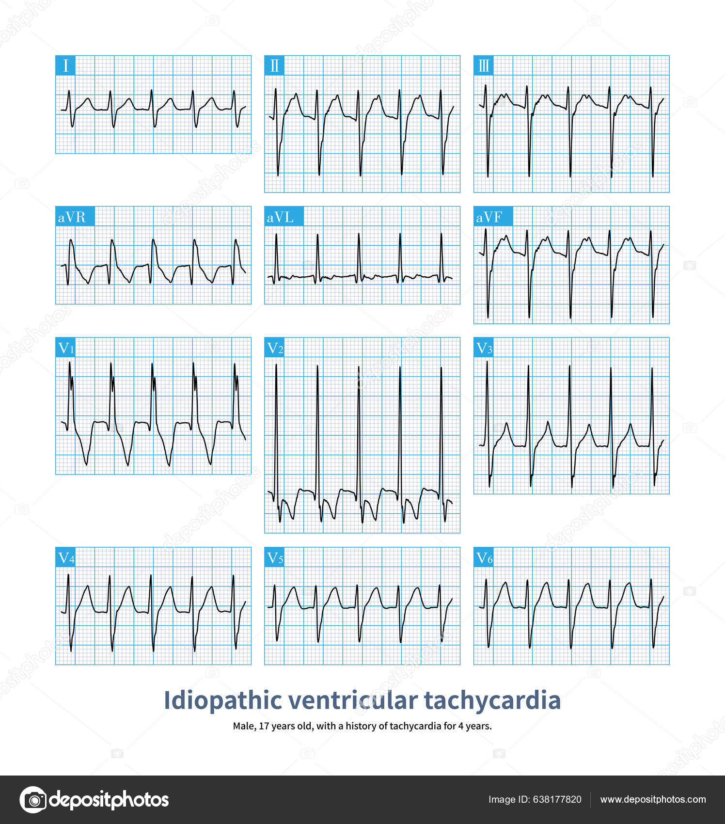 Ventricular Tachycardia Originating Left Posterior Fascicular Region ...