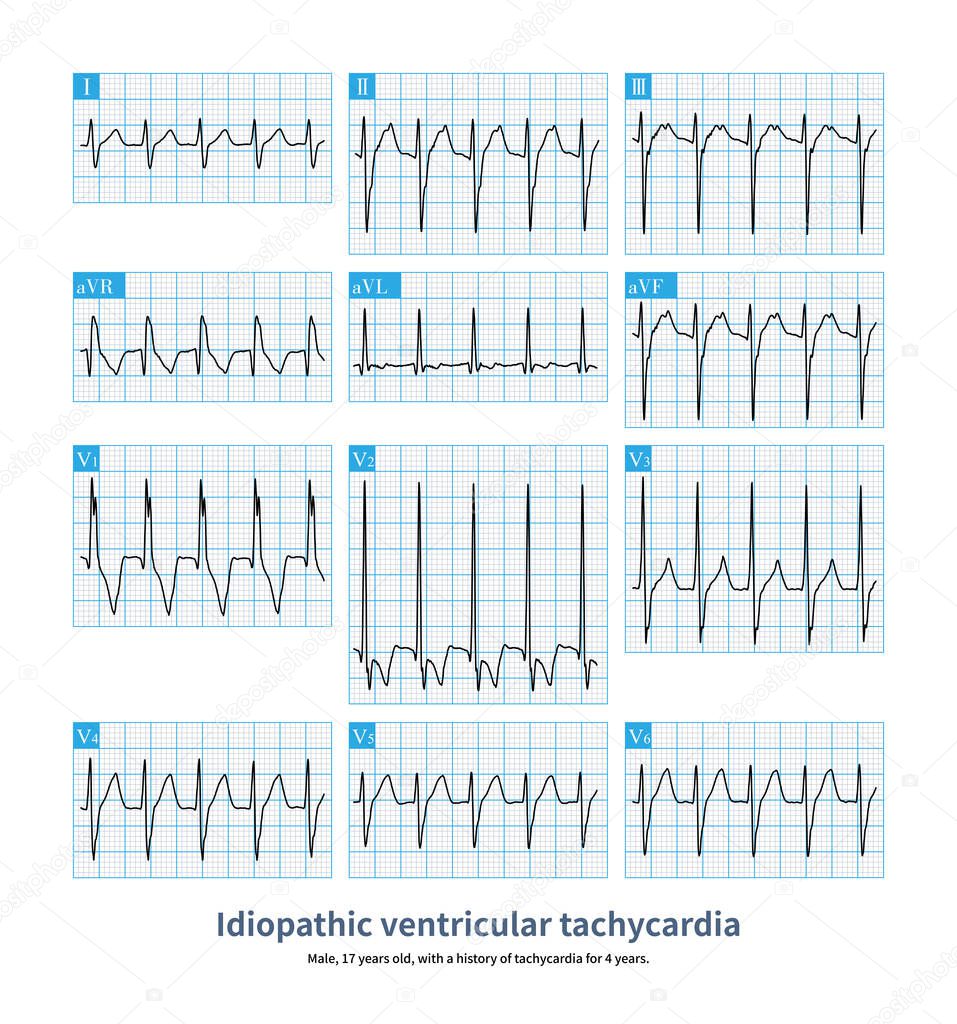 Ventricular tachycardia originating in the left posterior fascicular ...