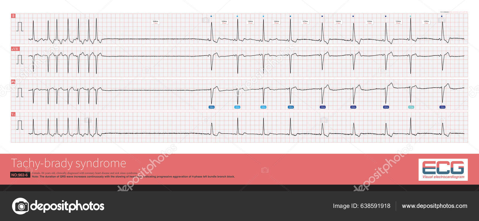 Daily Work Horizontal Represents Time Small Square Ecg Therefore ...
