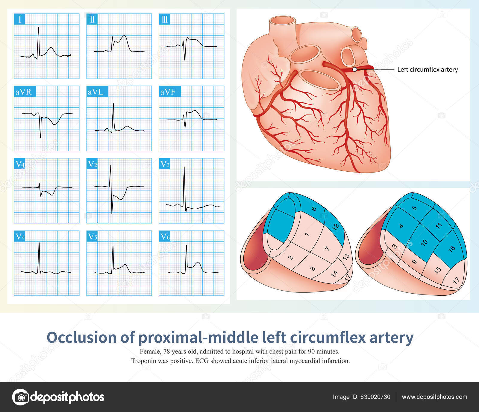 Occlusion Proximal Middle Left Circumflex Artery Can Lead Myocardial Infarction — Stock Photo ...