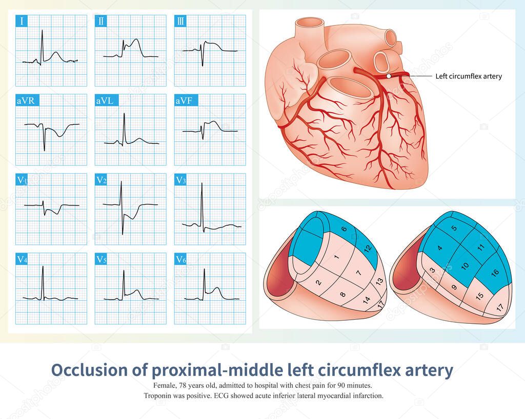 The occlusion of the proximal and middle left circumflex artery can ...