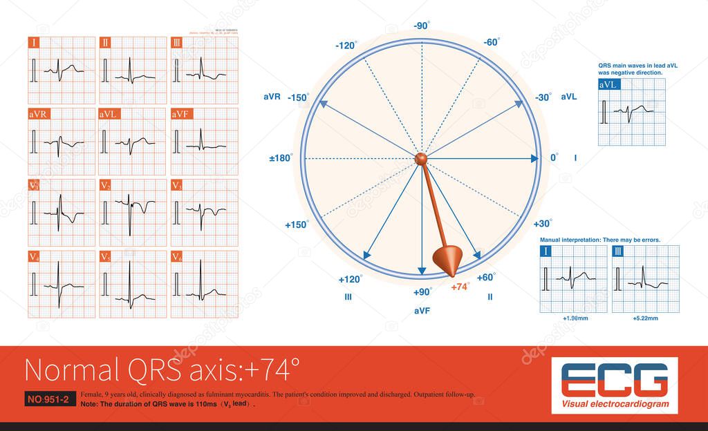 When the frontal QRS axis is located at +74, the QRS main wave in lead ...