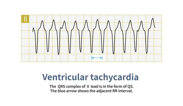 Ventricular tachycardia Stock Photos, Royalty Free Ventricular ...