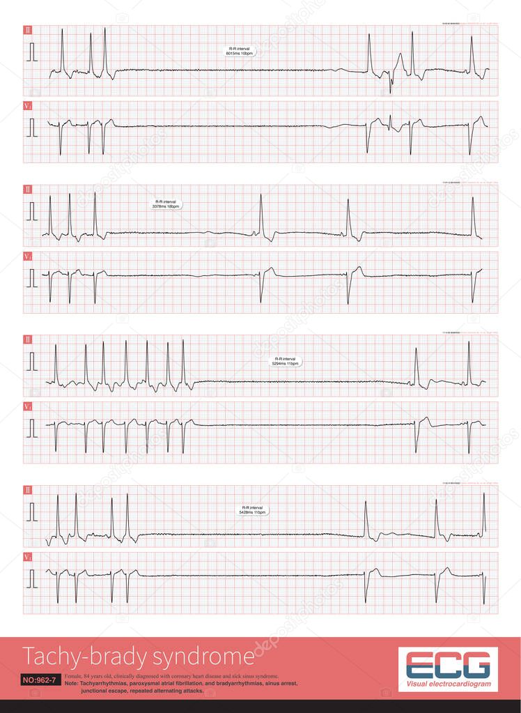 After the paroxysmal atrial fibrillation attack stopped, there was a ...