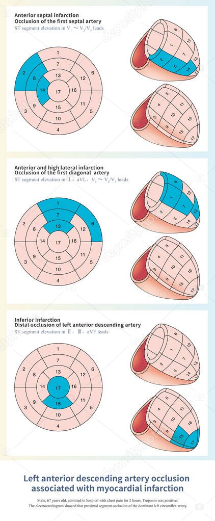 Occlusion Of The Left Anterior Descending Artery In Different Parts Causes Different Ranges Of