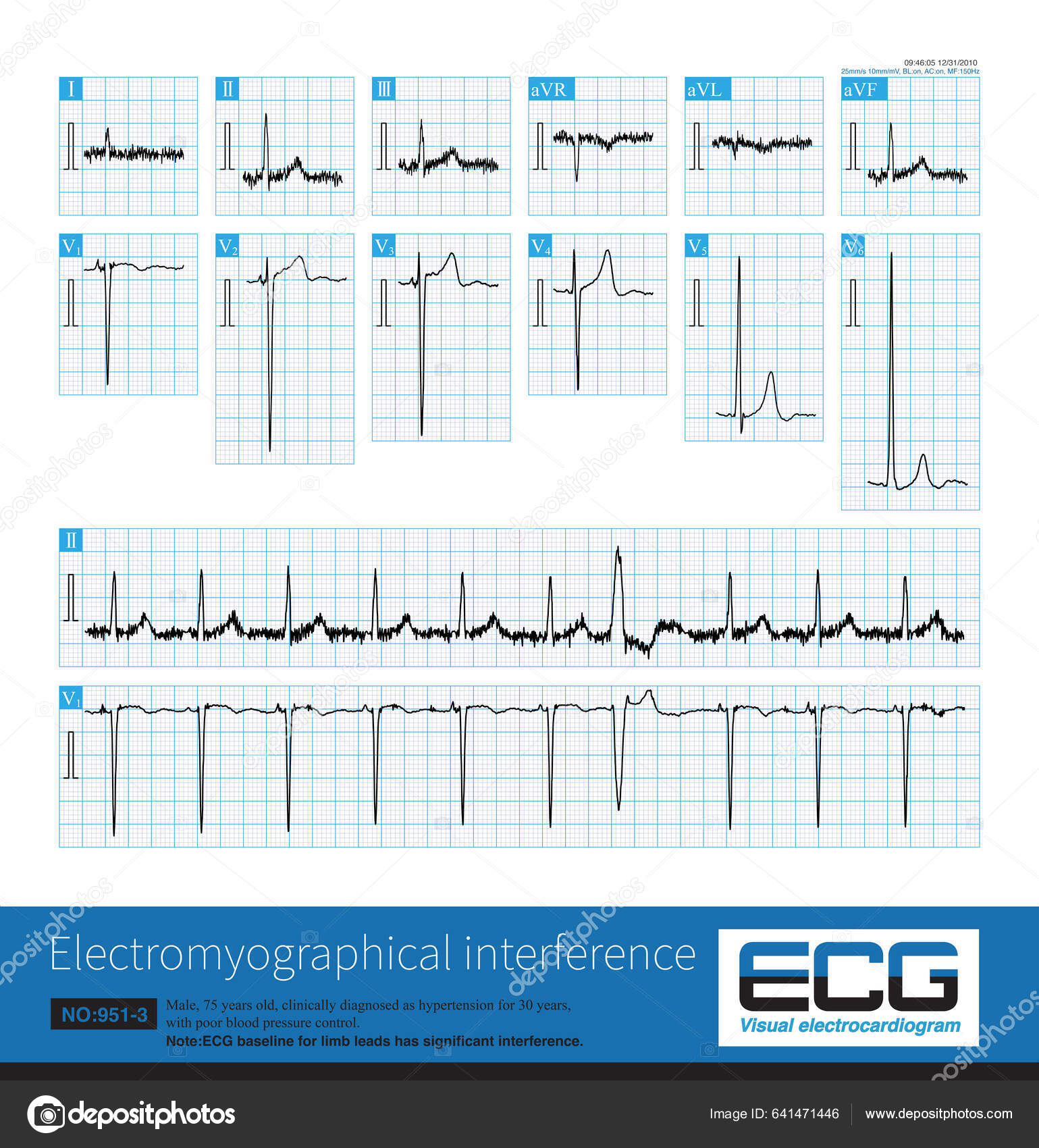 Cuando Línea Base Del Ecg Interferida Por Propia Señal Eléctrica ...
