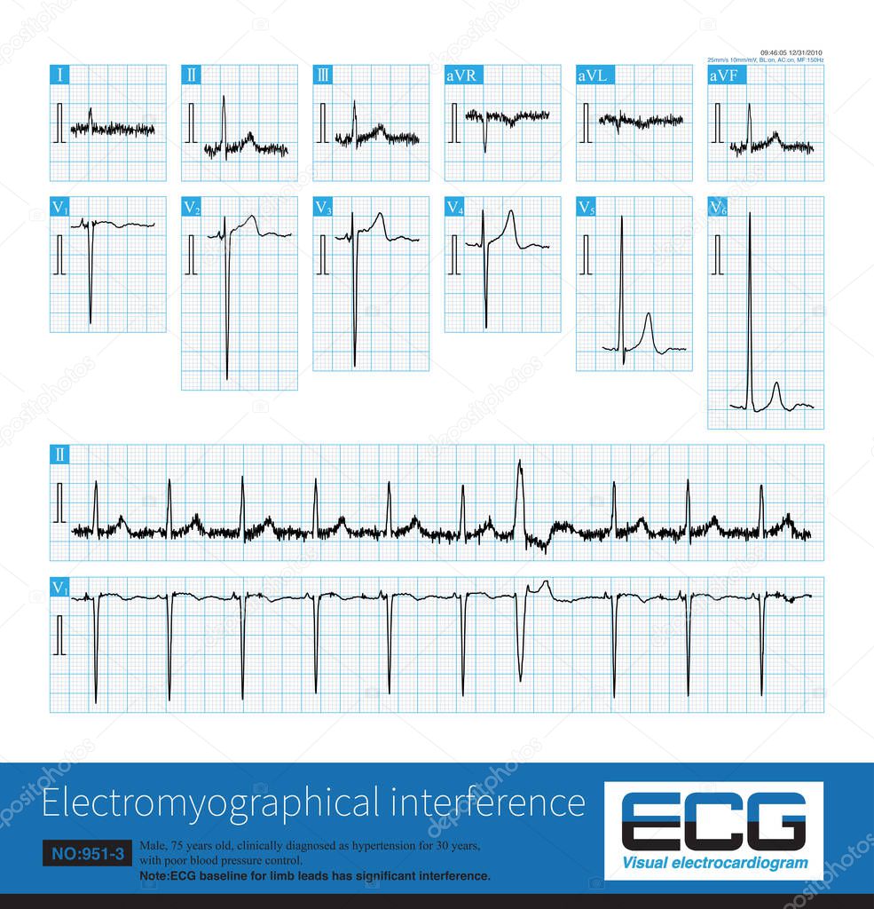 When the baseline of ECG is interfered by its own or external ...