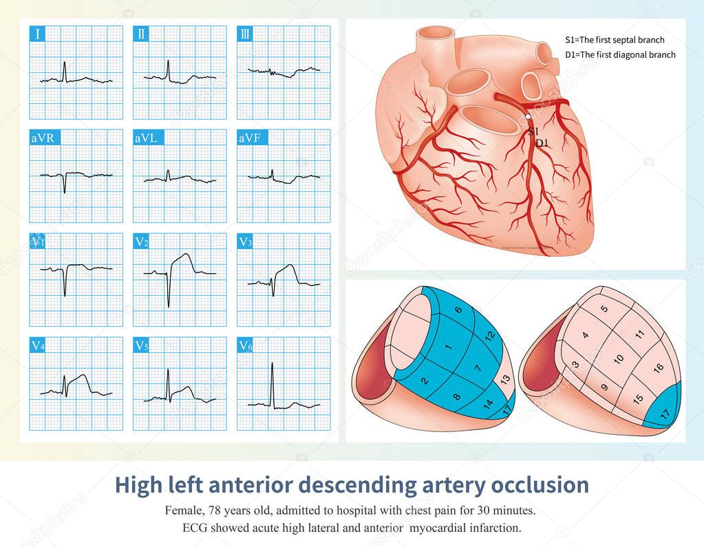 Cuando la oclusión de la DA se encuentra en el tronco común por encima ...