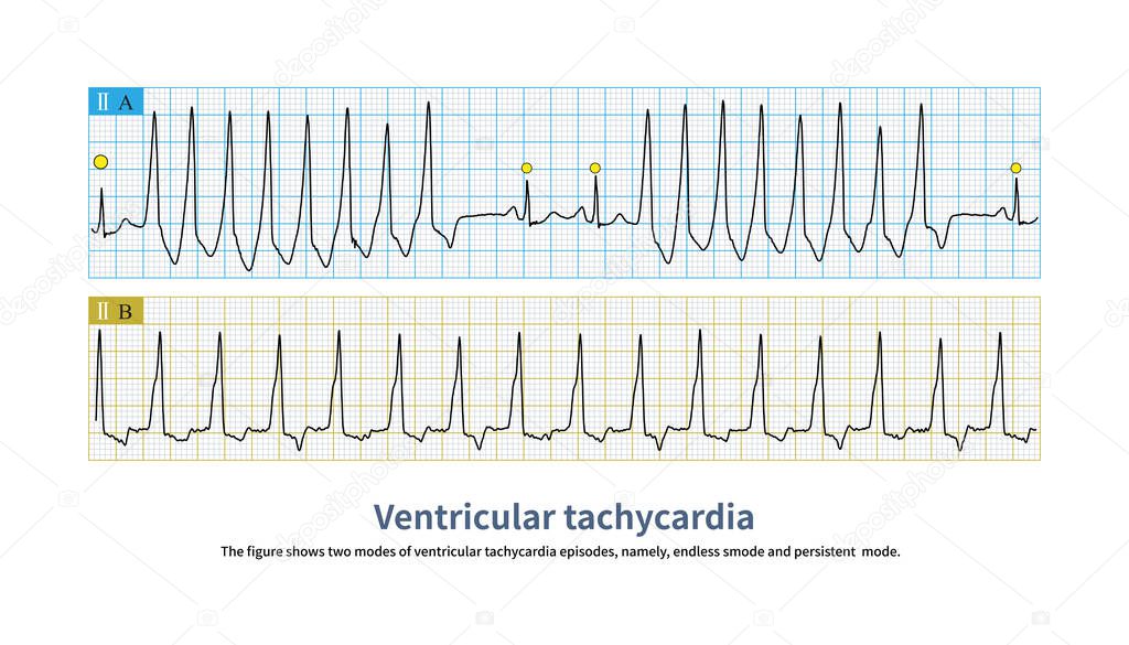 A es un patrón interminable de taquicardia ventricular, y el círculo ...