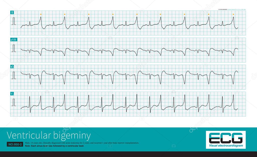 Some ventricular bigeminy are precursors of ventricular tachycardia, a ...