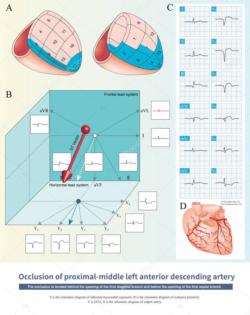 Cuando la oclusión de la DA afecta a la primera rama septal y la ...