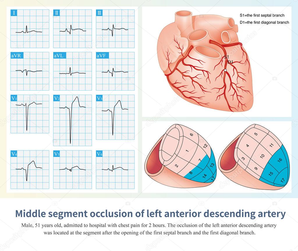 Electrocardiograma De Infarto De Miocardio Lateral