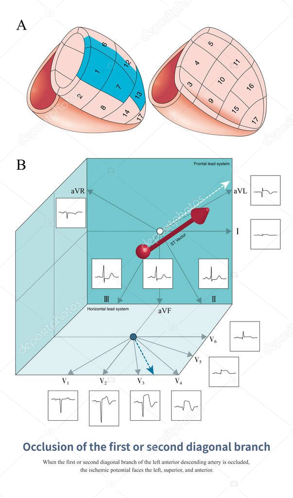 Cuando se ocluye la primera o segunda rama diagonal de la arteria ...