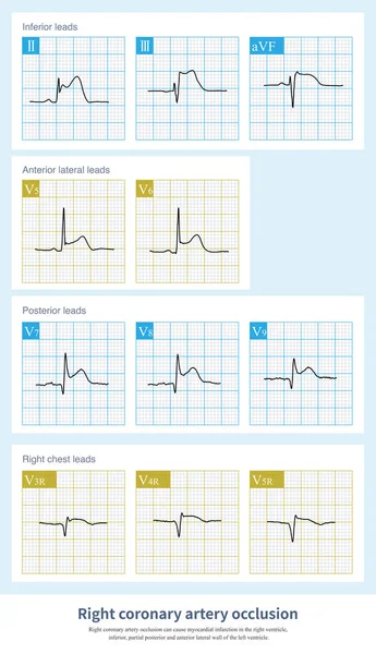 Acute Left Main Artery Occlusion Myocardial Infarct Area Left Coronary ...