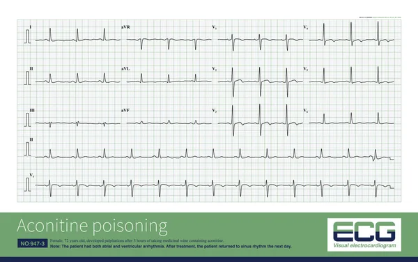 In aconitine poisoning, the atrium is inhibited, the amplitude of P ...