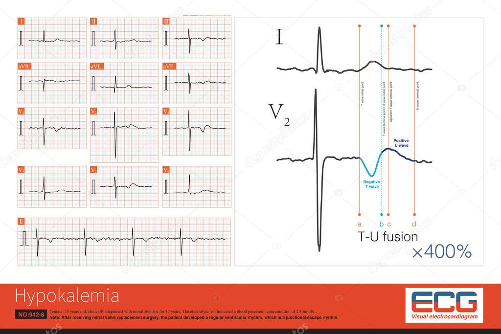 Cuando se produce hipopotasemia, la onda T invertida se fusiona con la ...