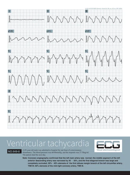 Ventricular escape rhythm Stock Photos, Royalty Free Ventricular escape ...