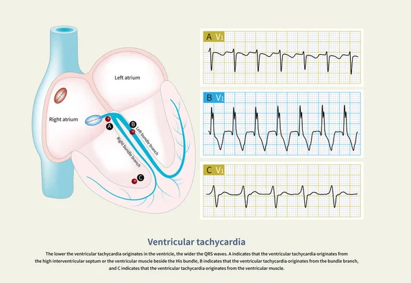 Ventricular tachycardia Stock Photos, Royalty Free Ventricular ...