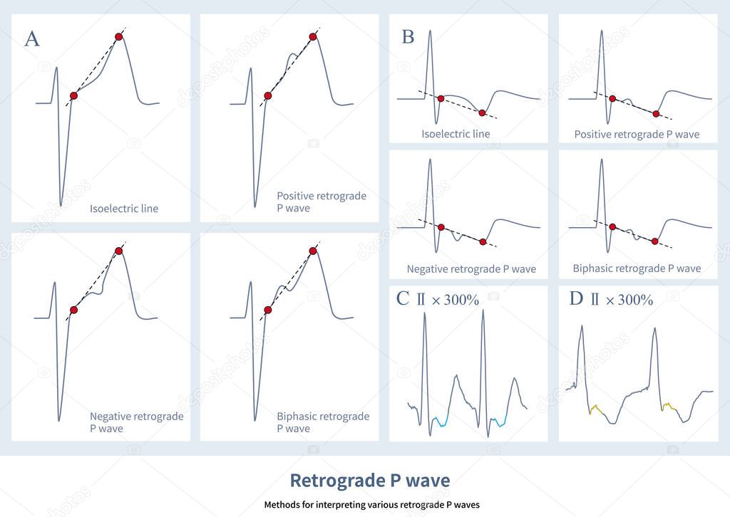 En el ECG, la onda P retrógrada puede ser una onda positiva, una onda ...